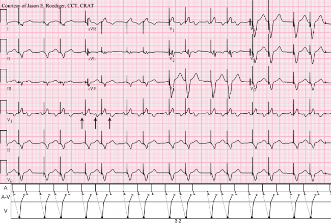 ICD | ECG Guru - Instructor Resources ICD | ECG Guru - Instructor Resources